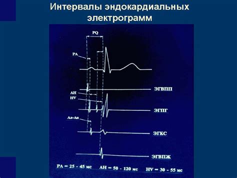 Аритмология и электрофизиология. Механизмы, диагностика аритмий ...
