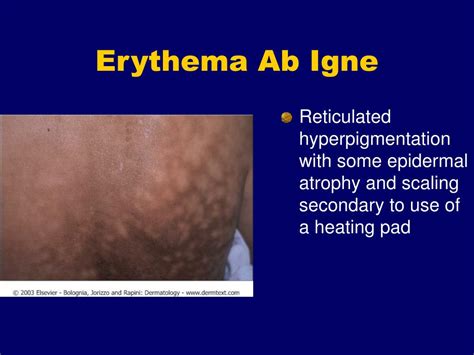 Ppt Dermatoses Resulting From Physical Factors Powerpoint