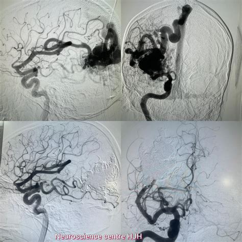 Curative Staged Onyx Embolization Of Brain Arteriovenous Malformation