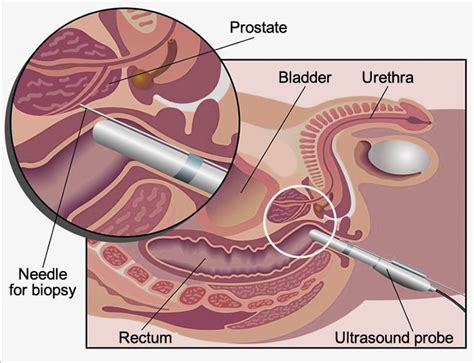 Bi Psia De Pr Stata Dr Andr Rezek Urologista Em Bras Lia Df