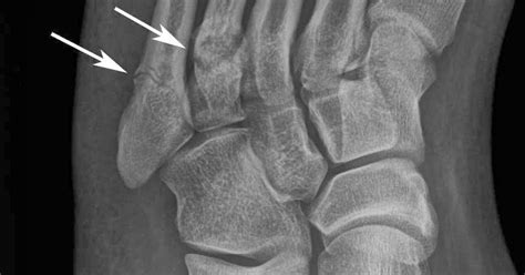 Rit Radiology Metatarsal Stress Fracture