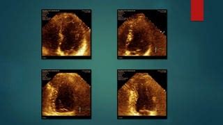 Treadmill Stress Echocardiogram Normal Pptx