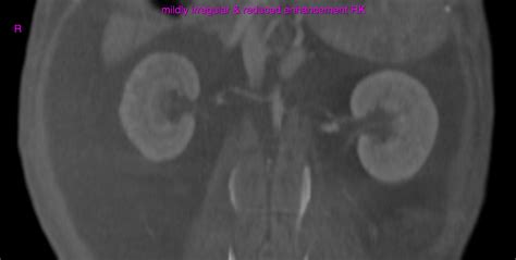Ct Bilateral Destructive Rhinitis With Lymphadenitis Chronic