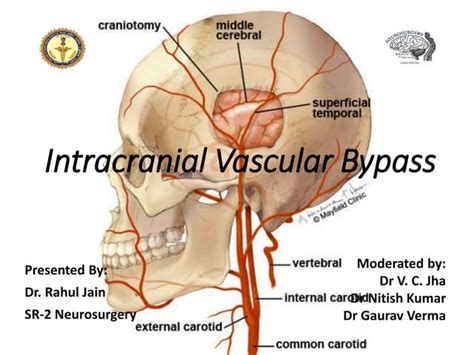 Intracranial Vascular Bypass Pptx