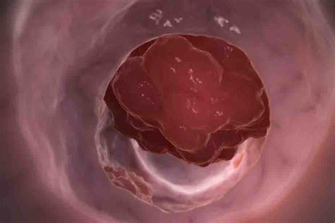 Endoscopic Polypectomy What It Is When It Is Performed