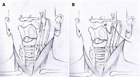 Pyriform Sinus Fistula