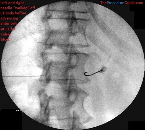 Fluoroscopic Guided Celiac Plexus Splanchnic Nerve Block Technique And Overview The