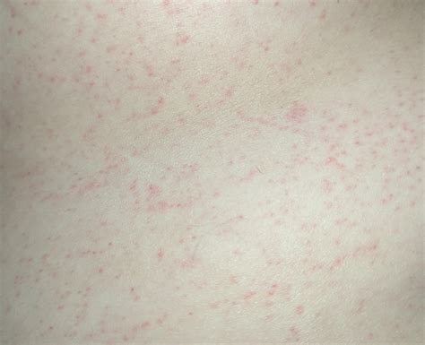 Heat Rash Over Entire Body Rhyperhidrosis