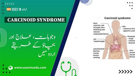 Carcinoid Syndrome Uses In Urdu