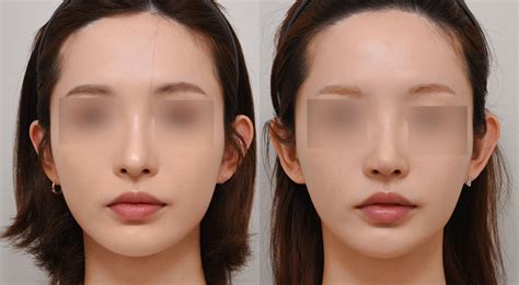 코끝코젤코비주교정 전후사진 자연스러운 아름다움 비앤영의원 Beandyoung Clinic