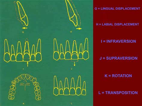 Classification Of Malocclusion Ppt Classification Of Malocclusion Ppt
