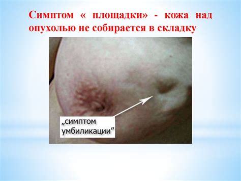 Ранняя диагностика рака молочной железы презентация онлайн