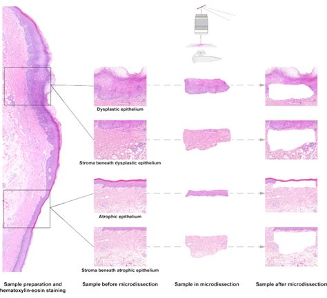 Isolation Of Cells With Morphological And Spatial Information From Oral Submucous Fibrosis