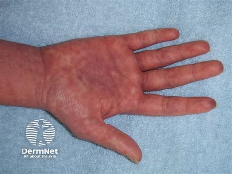 Anticonvulsant Drugs And The Skin