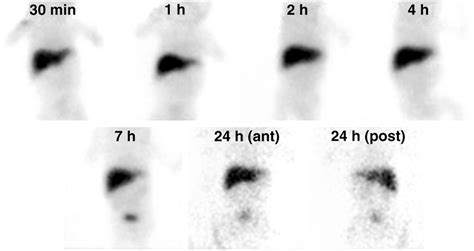 Abnormal Gallbladder Hida Scan Results