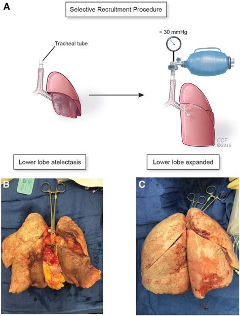 Atelectasis Diagram