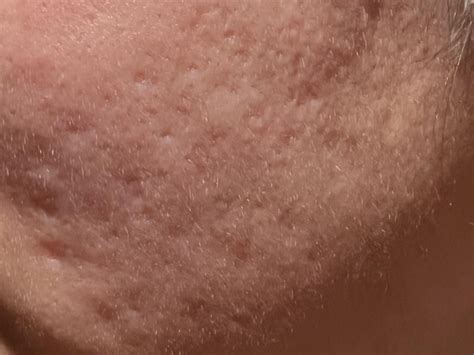Discoloration Under Breast How Do I Fix This I Tried Antifungal