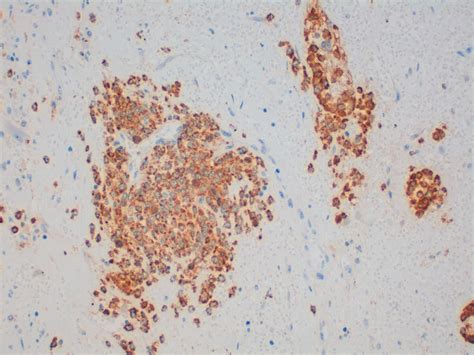 Pathology Outlines Myeloperoxidase Mpo