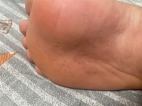 발바닥 무좀 지식in