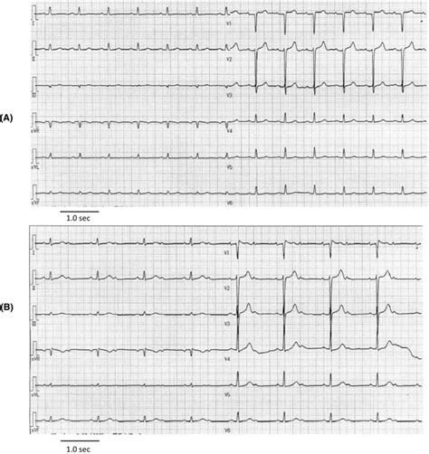 A 12lead Electrocardiogram Of The Patient At The Diagnosis Of POEMS