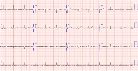 Dr Smiths Ecg Blog What Does A Final Diagnosis Of Stemi Vs Nstemi Depend Upon