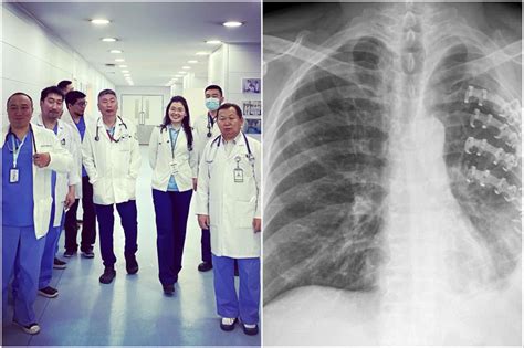 ГССҮТ ийн эмч нар цээжний дурангийн мэс засал эмчилгээг орон нутагт нэвтрүүллээ