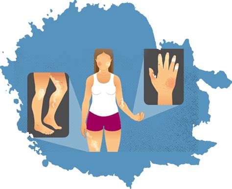 Systemic Sclerosis Scleroderma Treatment In Jaipur By Dr Bhupendra