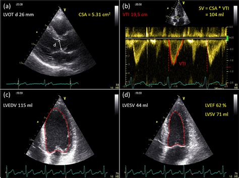 Frontiers The Utility Of Cardiac Reserve For The Early Detection Of