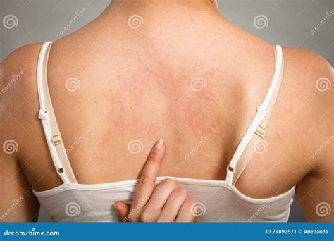 Woman Scratching Her Itchy Back With Allergy Rash Stock Image Image
