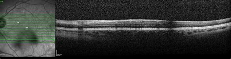 Oct B Scan Of A Symptomatic Patient The Vitreous Opacities Seen In The