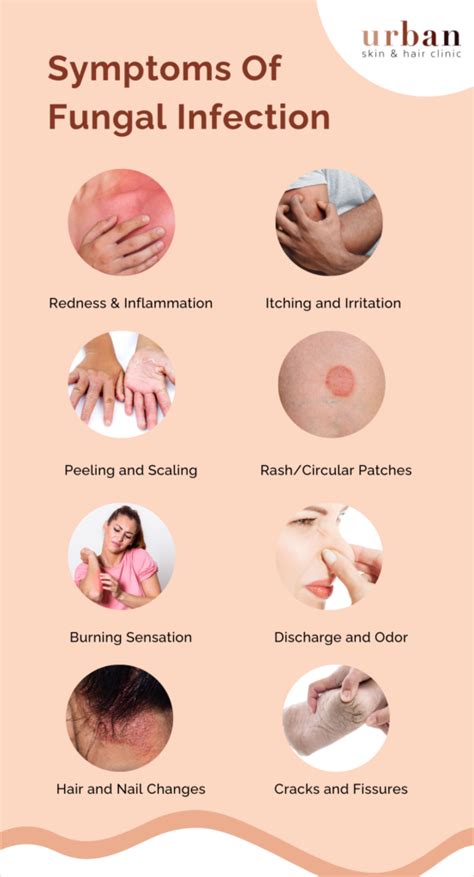 Fungal Infection Types Causes Symptoms And Treatment Urban Skin And Hair Clinic