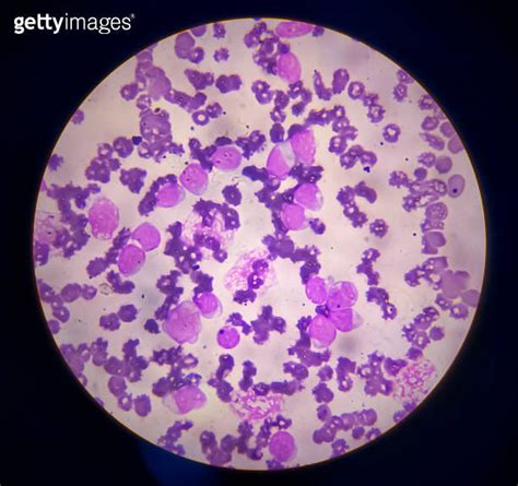 Acute Leukemia All Acute Lymphoblastic Leukemia Micrograph 이미지