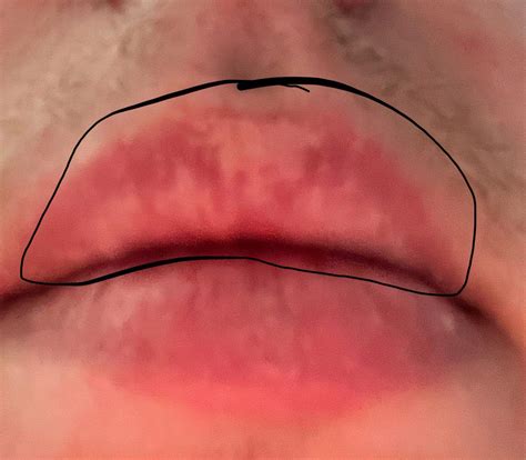 Was Ist Das An Der Lipe Gesicht Lippe