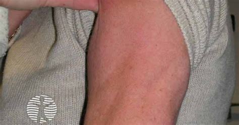 Lipodystrophy Image