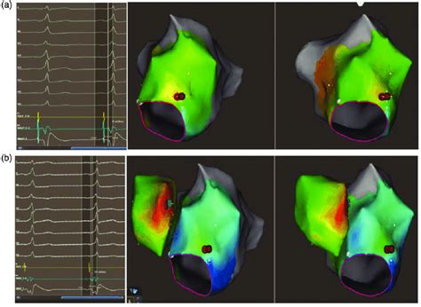 A Intra Cardiac Electrograms From The Mapping Catheter At The Download Scientific Diagram