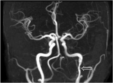 Arterial Dissections Noted In Both Vertebral Arteries On Mri