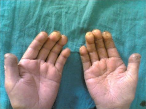 Digital Pitted Scarring In The Same Patient Open I