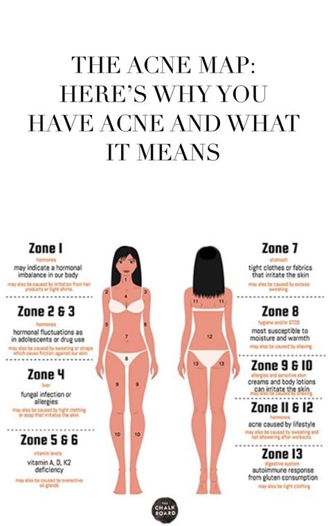 What Your Acne Map Is Telling You The Chalkboard Acne Mapping Body