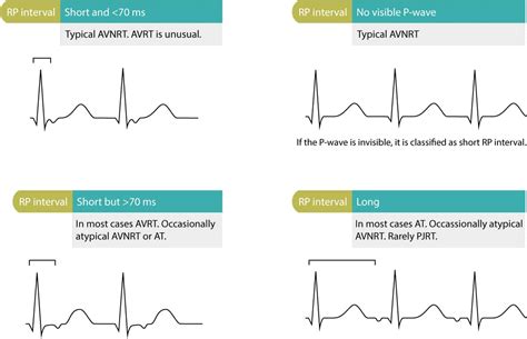 Figure X Differential Diagnoses Based On Rp Interval Ecg Learning