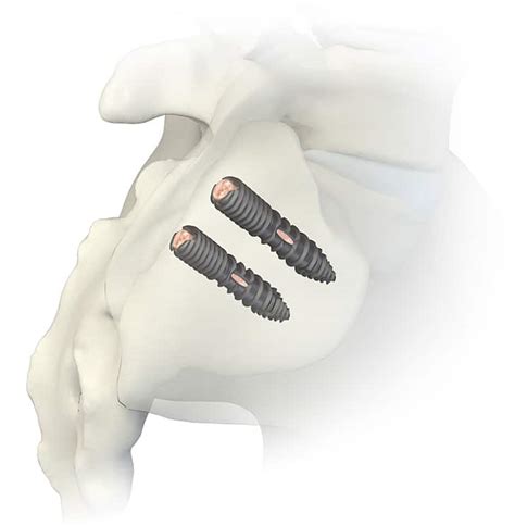 Oblique Sacroiliac Joint Fusion Siros O 3d Printed Genesys Spine
