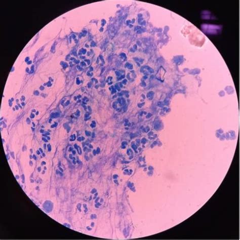 Gram Staining Photograph Showed Gram Positive Coccus Bacteria