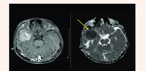 Lymphoma Right Temporal Mass Lesion Showing Intense Enhancement And Download Scientific