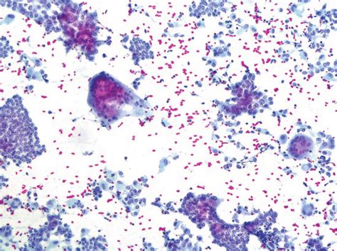 12 Papillary Thyroid Carcinoma Multinucleated Giant Cells Accompany