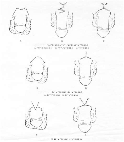 阴茎延长术须严防并发症