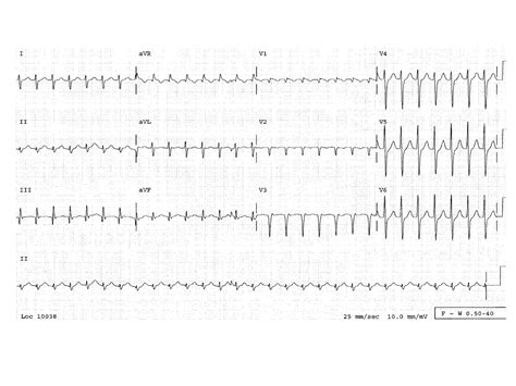 Approach To Svt Ppt