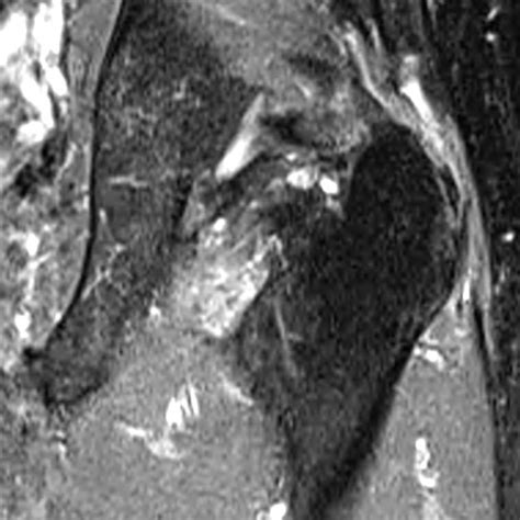 Endoscopic Treatment For Micropuncture Using Microfracture Awl