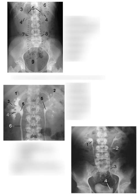 X Ray Kidneys RAD 112 IVU Worksheet IVU Review Diagram Quizlet