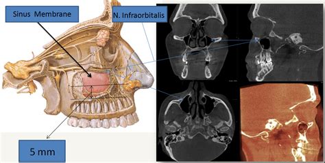Retention Cyst Of The Maxillary Sinus Image