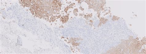 Assessing Her2 Ihc With Edge Artifacts