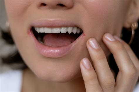 Cheilite Angolare Che Cosè E Come Si Cura Donnad